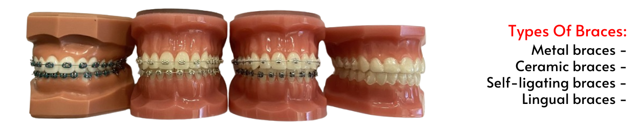 Braces - Dental Experts Diary